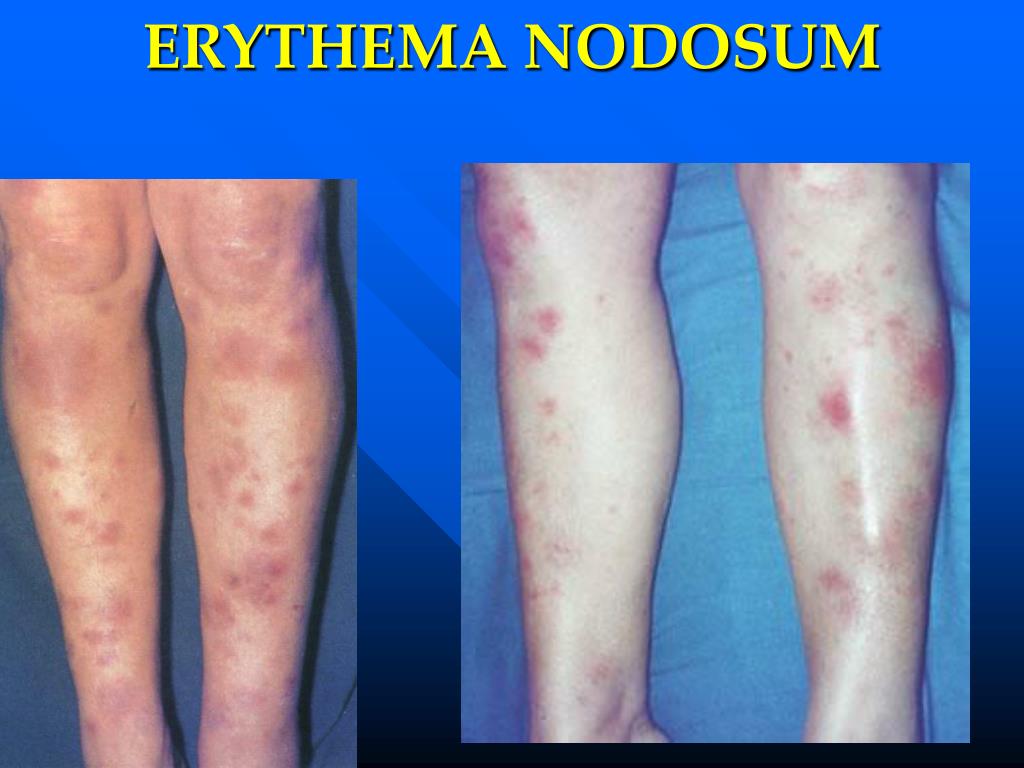 PPT - DERMATOLOGICAL MANIFESTATIONS OF SYSTEMIC DISEASE PowerPoint ...