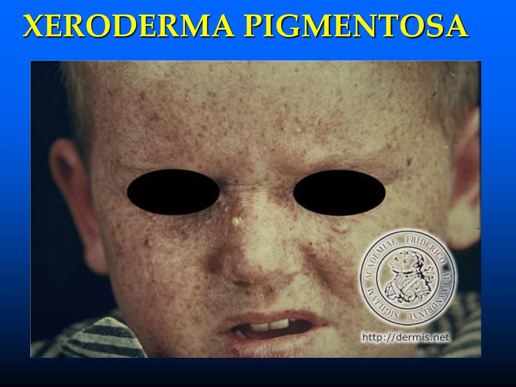 PPT - DERMATOLOGICAL MANIFESTATIONS OF SYSTEMIC DISEASE PowerPoint ...