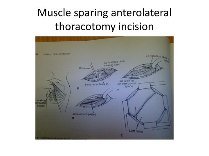 PPT - THORACIC INCISIONS PowerPoint Presentation - ID:803166