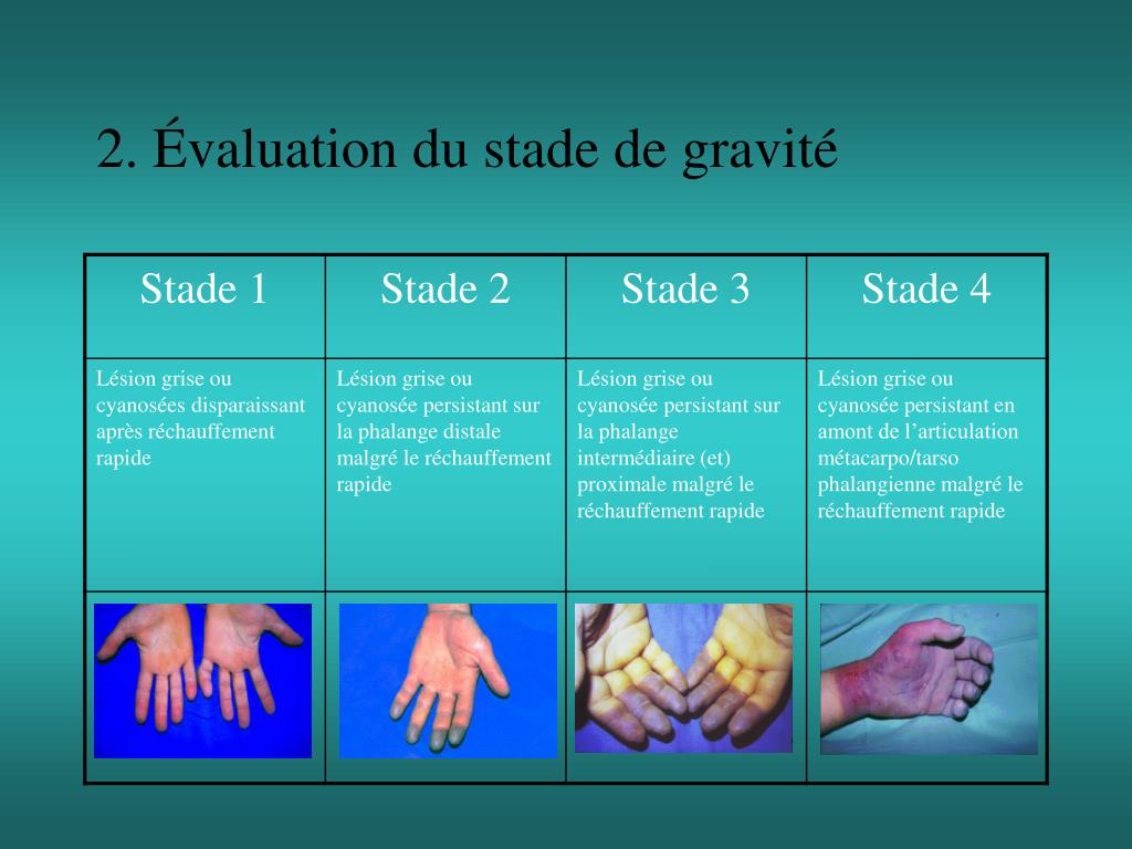 PPT - Prise en Charge Gelures des Extrémités datant de moins de 48 ...