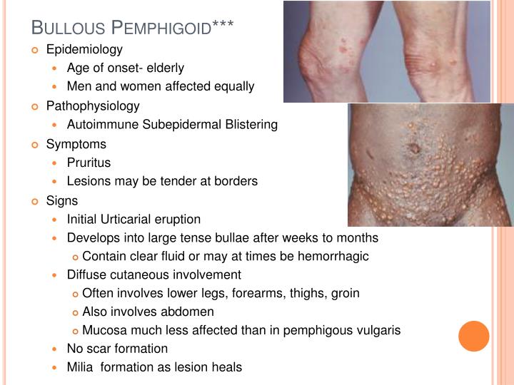 PPT - Bullous diseases PowerPoint Presentation - ID:806425
