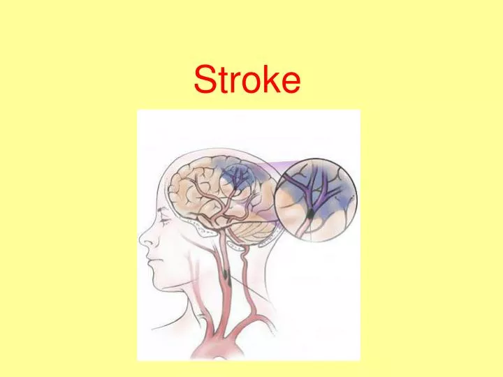 PPT - Stroke PowerPoint Presentation, free download - ID:811583