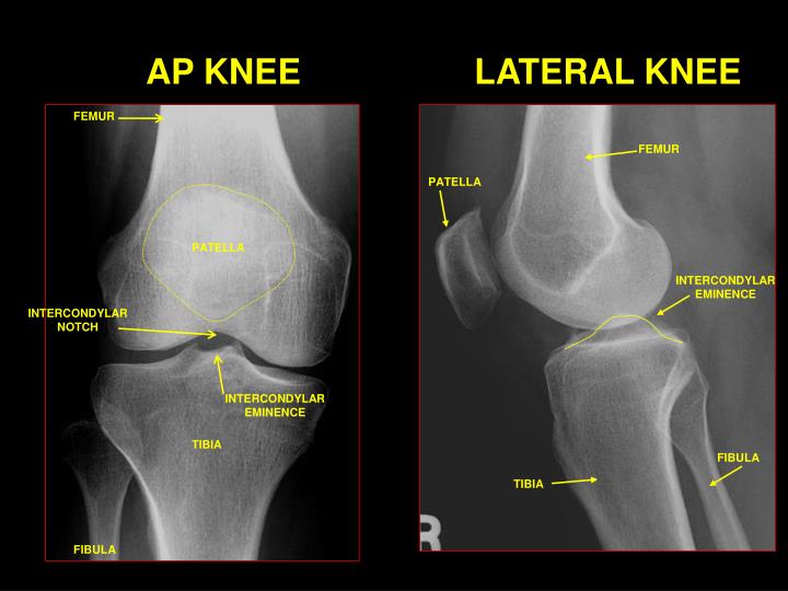 PPT - AP RIGHT HIP PowerPoint Presentation - ID:813234