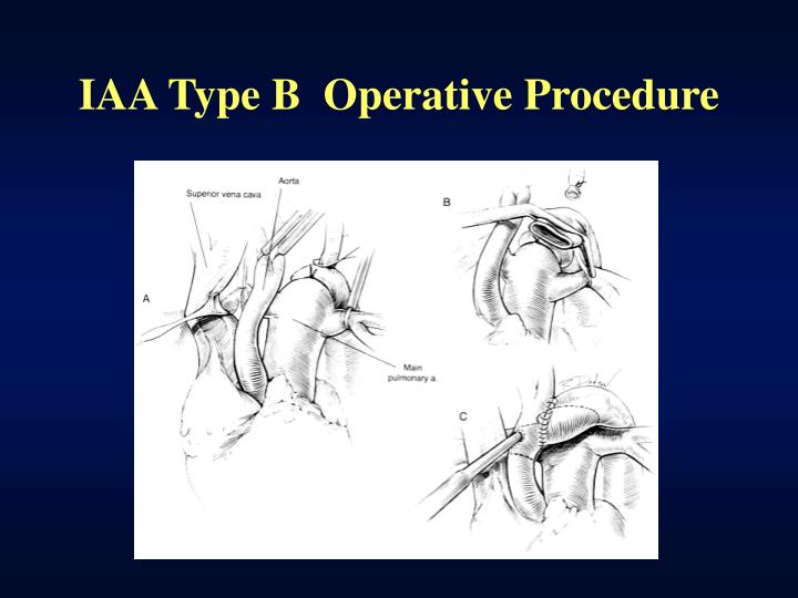PPT - Interrupted Aortic Arch PowerPoint Presentation - ID:818509