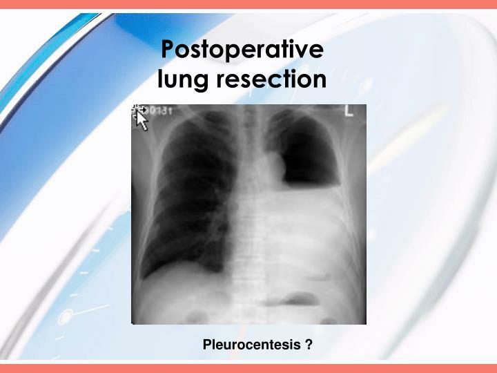 PPT - Lung resection PowerPoint Presentation - ID:819564