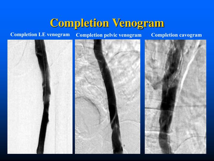 PPT - Deep Vein Thrombosis PowerPoint Presentation - ID:822146