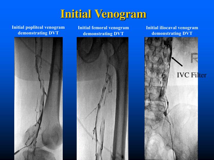PPT - Deep Vein Thrombosis PowerPoint Presentation - ID:822146