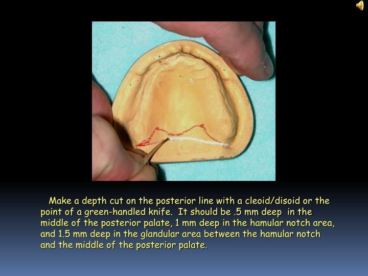 PPT - Posterior Palatal Seal PowerPoint Presentation - ID:826117