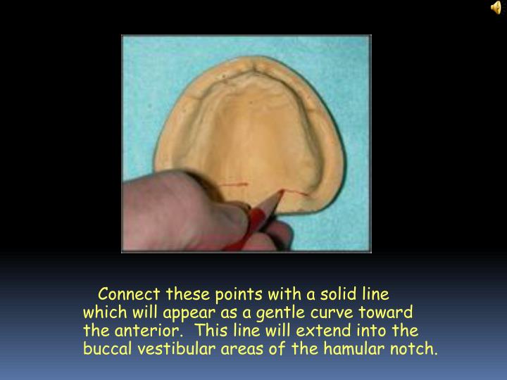 PPT - Posterior Palatal Seal PowerPoint Presentation - ID:826117