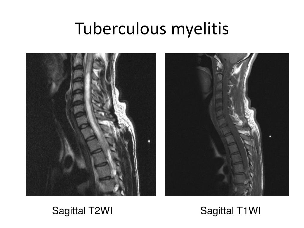 PPT - THE DIFFERENT FACES OF CENTRAL NERVOUS SYSTEM TUBERCULOSIS: A ...