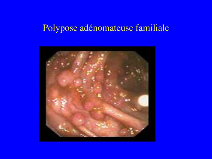 PPT - Polypes recto-coliques PowerPoint Presentation - ID:828294