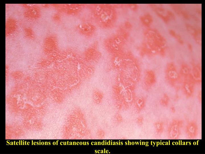PPT - Chronic oral candidiasis of the tongue and mouth corners (angular ...