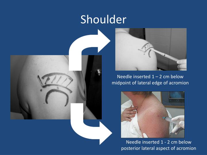 PPT - Joint and Soft Tissue Injection in Primary Care PowerPoint ...