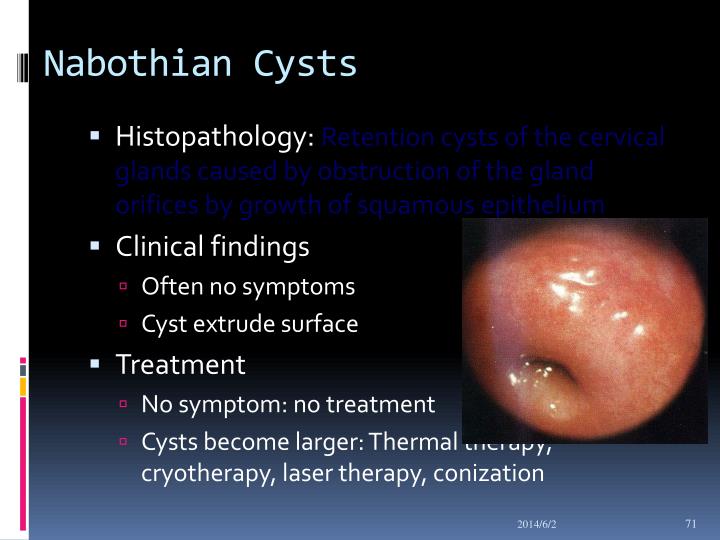 Nabothian Cyst