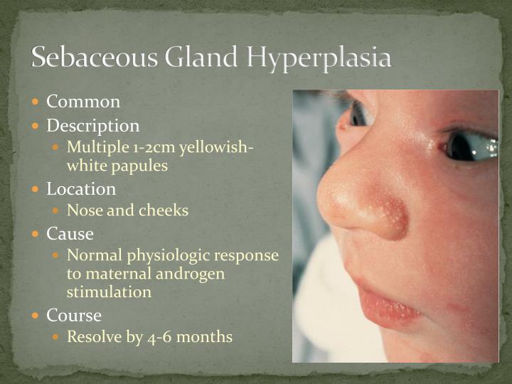 PPT - Other Infantile Rashes PowerPoint Presentation - ID:834259