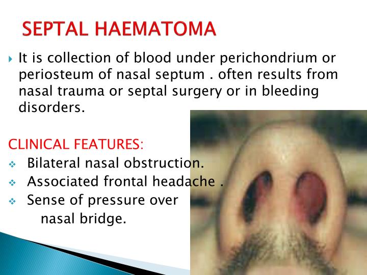 PPT - NASAL SEPTUM AND ITS DISEASES PowerPoint Presentation - ID:834932