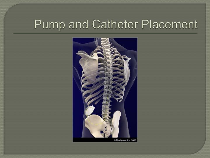 PPT - Intrathecal Baclofen Pump PowerPoint Presentation - ID:837111