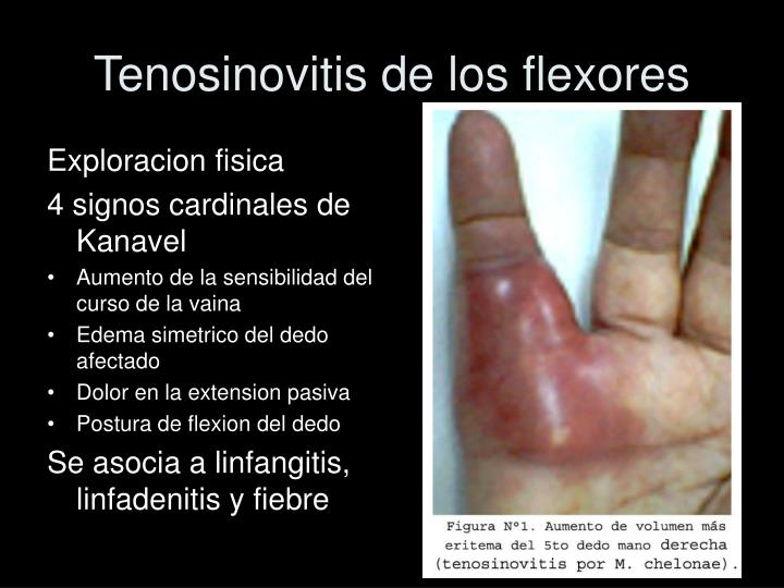 PPT - Infecciones de la mano PowerPoint Presentation - ID:837661