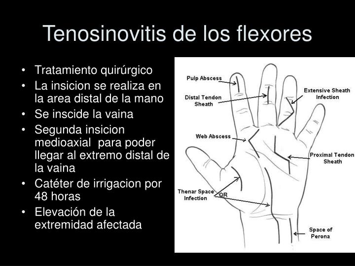 PPT - Infecciones de la mano PowerPoint Presentation - ID:837661
