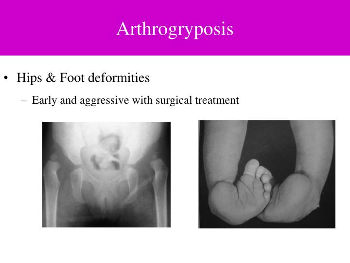 PPT - Arthrogryposis and Amyoplasia PowerPoint Presentation - ID:839019