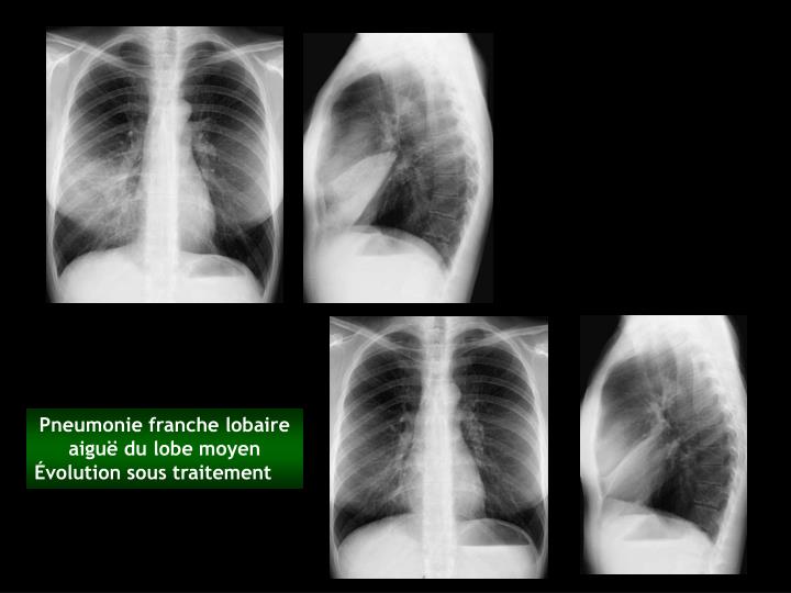 PPT - Confrontations anatomo-radiologiques infections pulmonaires ...