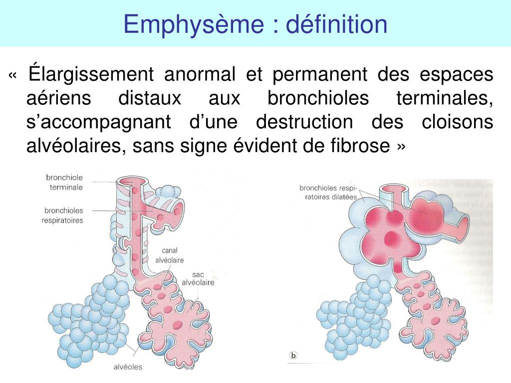 Lésion Emphysème Ide | Les Différents Emphysèmes Pulmonaires – EVMJI
