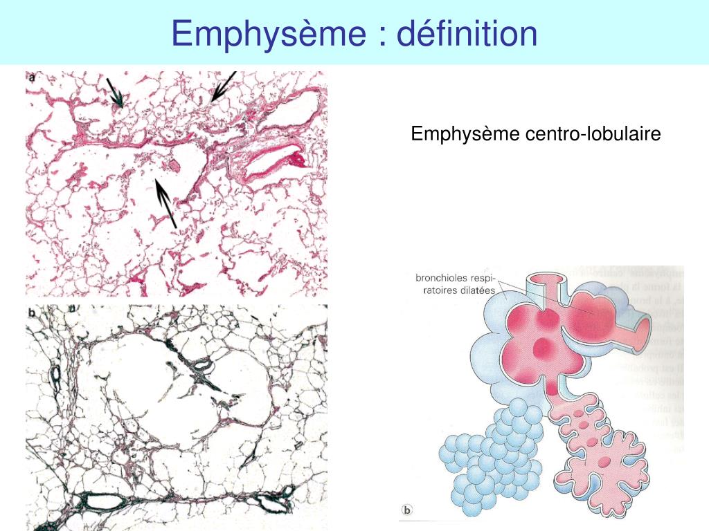 PPT - Traduction anatomo-pathologique des maladies chroniques ...