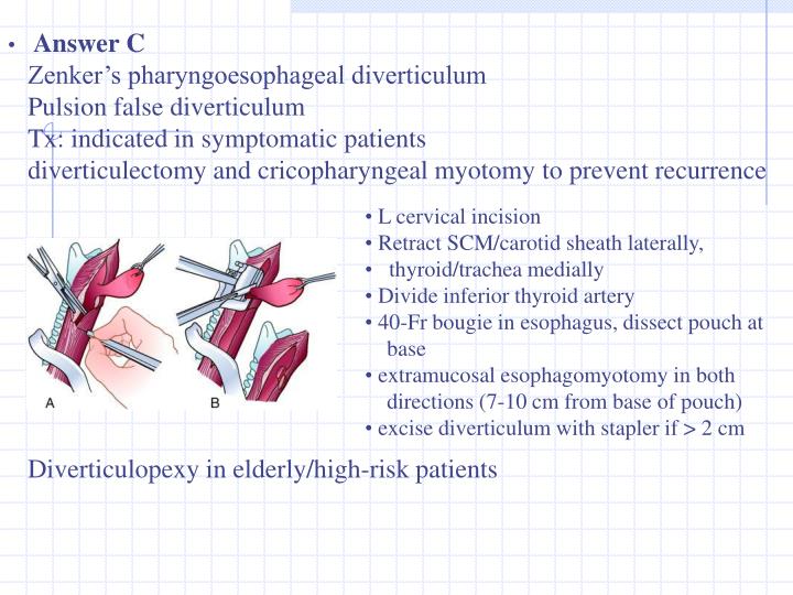PPT - a. Diverticulectomy and myotomy b. Myotomy alone c ...