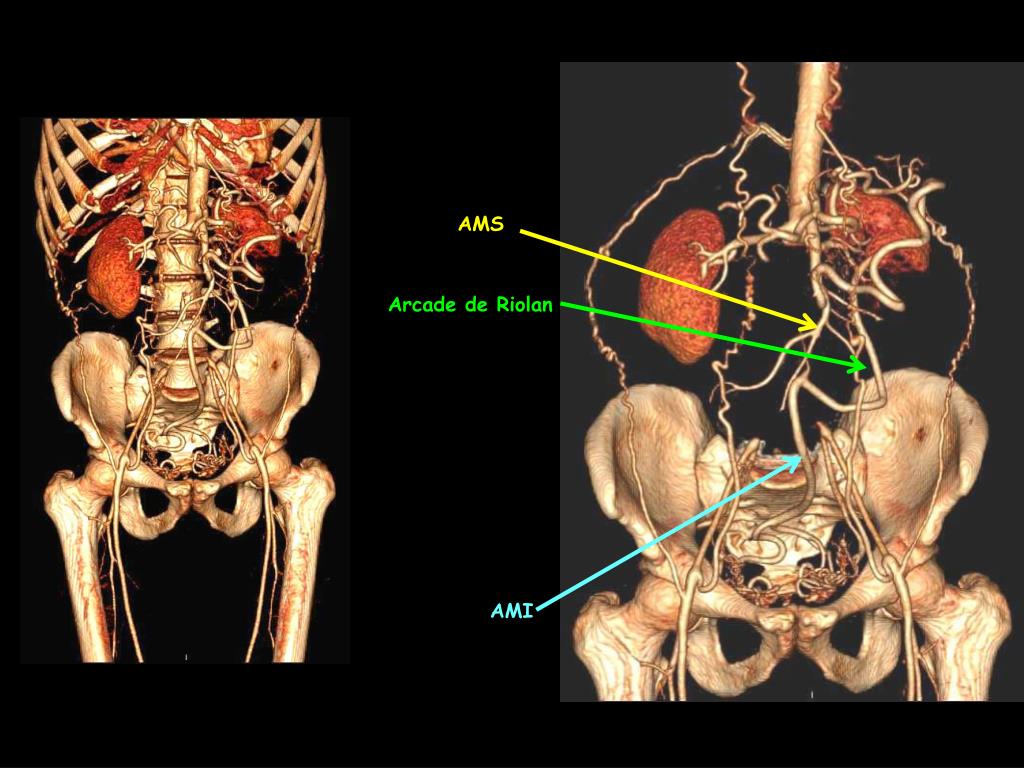 PPT - Homme de 48 ans, tabagique actif, ayant présenté un 1 er épisode ...