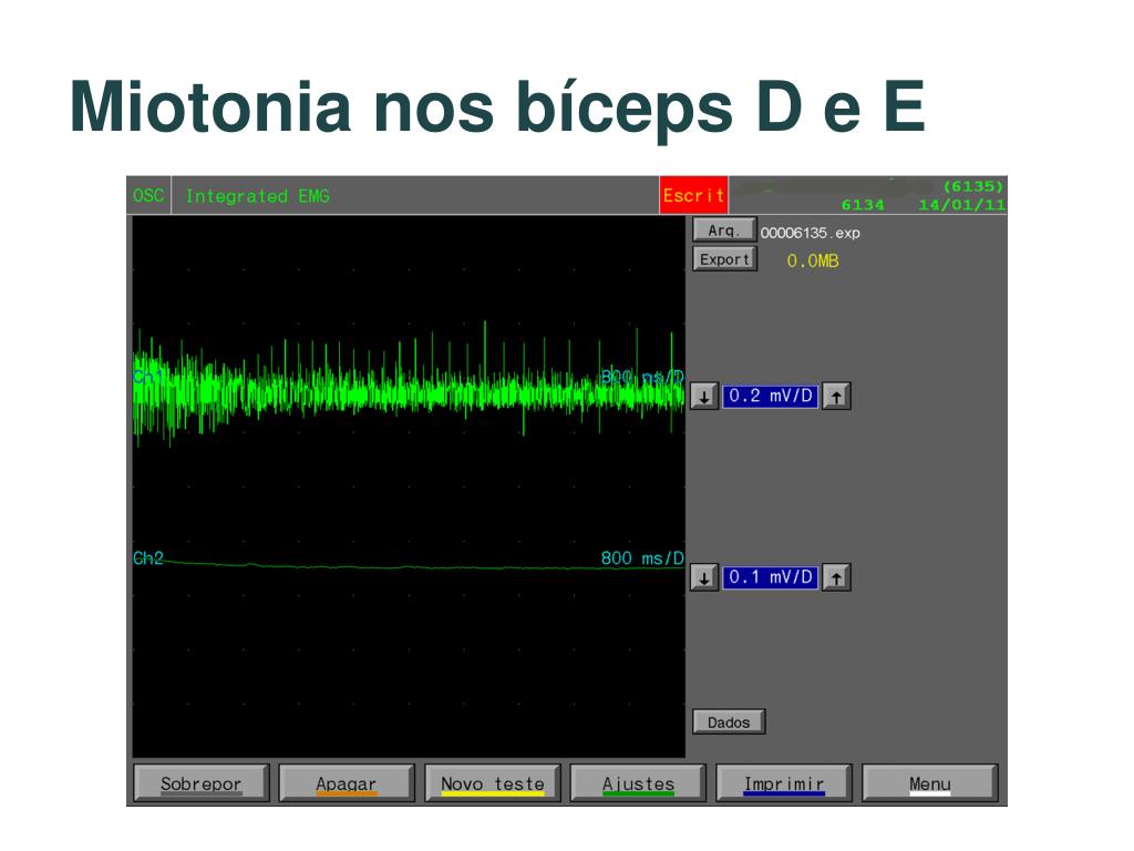 PPT - VIII Simpósio Nacional De Eletromiografia - IICS - SP PowerPoint ...