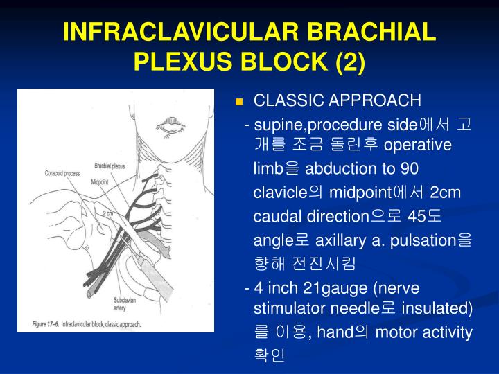 Chapter 14. Infraclavicular Brachial Plexus Block – JYNFLT