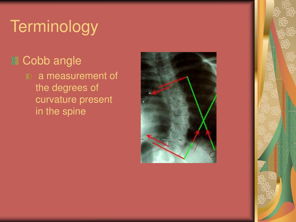 PPT - Treatment Options for Adolescent Idiopathic Scoliosis PowerPoint ...