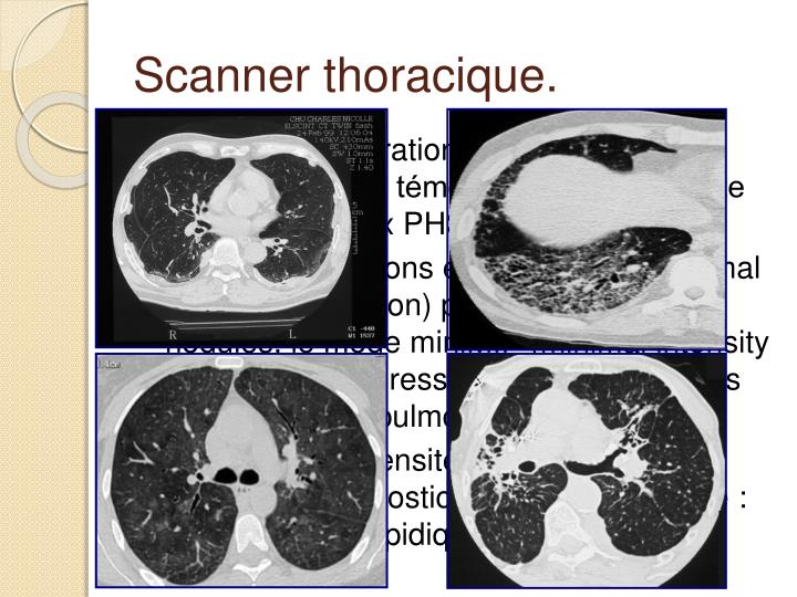 PPT - Pathologie pulmonaire infiltrative aiguë en réanimation ...
