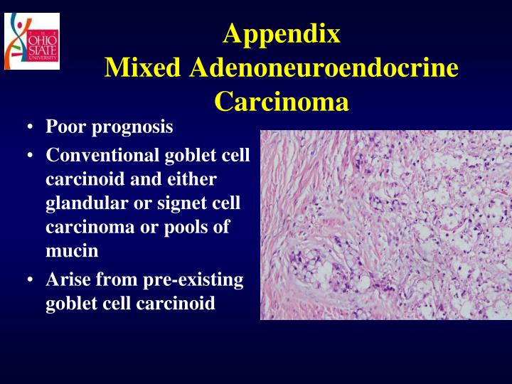 PPT - The Pathology of Neuroendocrine Tumors: Diagnosis, Grading and ...