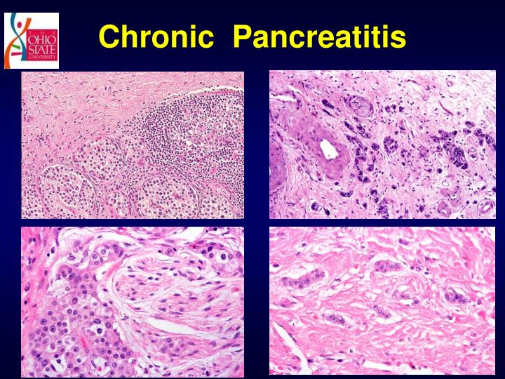 Pancreatitis Grading