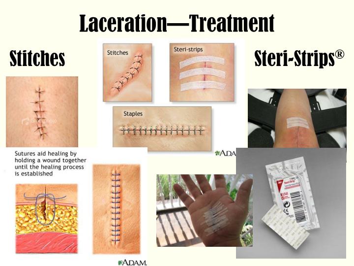 PPT - Skin Wounds Classification PowerPoint Presentation - ID:853573