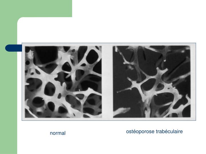 PPT - PATHOLOGIE OSSEUSE . PowerPoint Presentation - ID:853692