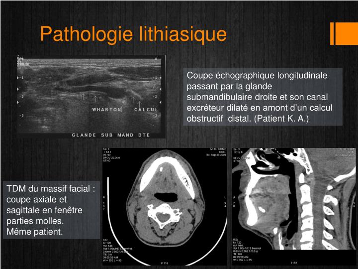 PPT - PATHOLOGIE NON TUMORALE DES GLANDES SALIVAIRES PRINCIPALES ...