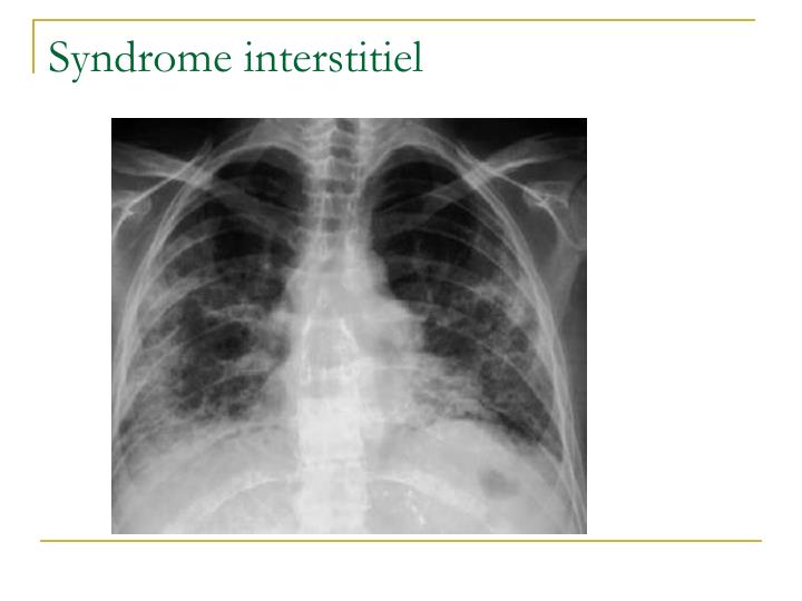 PPT - PNEUMOPATHIE PowerPoint Presentation - ID:855784