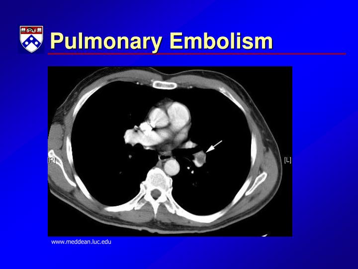 PPT - Approach to Chest Pain in the ED PowerPoint Presentation - ID:859542