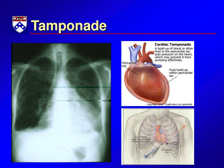 PPT - Approach to Chest Pain in the ED PowerPoint Presentation - ID:859542
