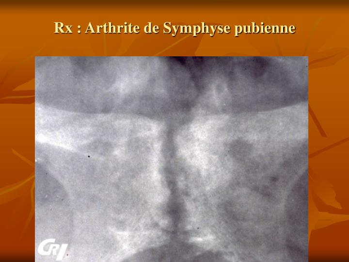 PPT - LA SPONDYLARTHRITE ANKYLOSANTE PowerPoint Presentation - ID:859813