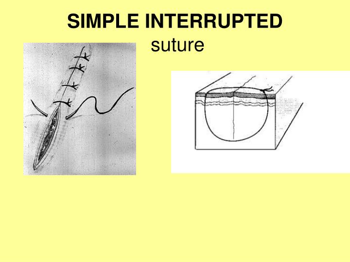 PPT - Suturing Basics PowerPoint Presentation - ID:861706