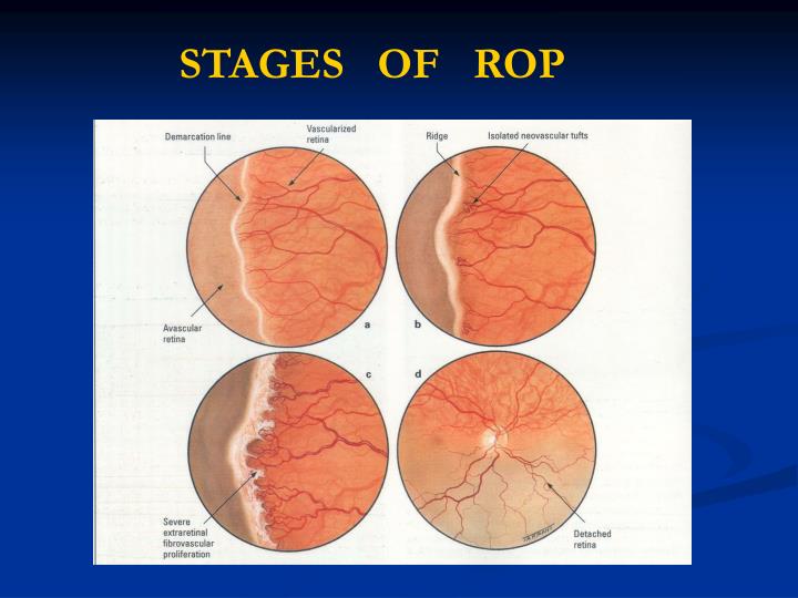 PPT - RETINOPATHY OF PREMATURITY PowerPoint Presentation - ID:861925