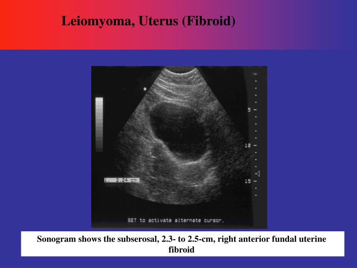 PPT - Leiomyoma, Uterus (Fibroid) PowerPoint Presentation - ID:862850