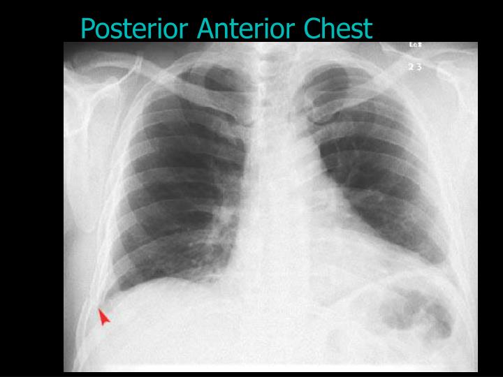 Posterior Anterior Chest X Ray