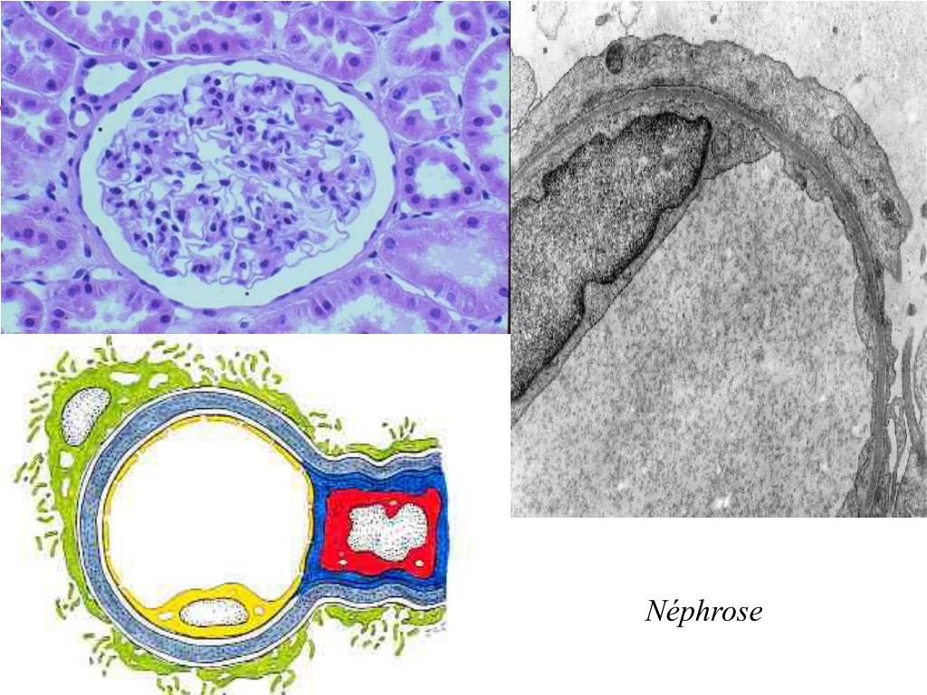 PPT - Physiopathologie des glomérulopathies primitives et des autres ...
