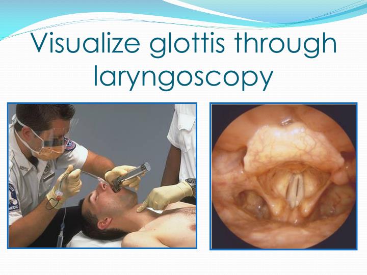 PPT - Orotracheal Intubation PowerPoint Presentation - ID:868329