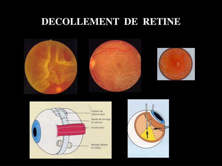 PPT - SEMIOLOGIE OPHTALMOLOGIQUE PowerPoint Presentation - ID:869185