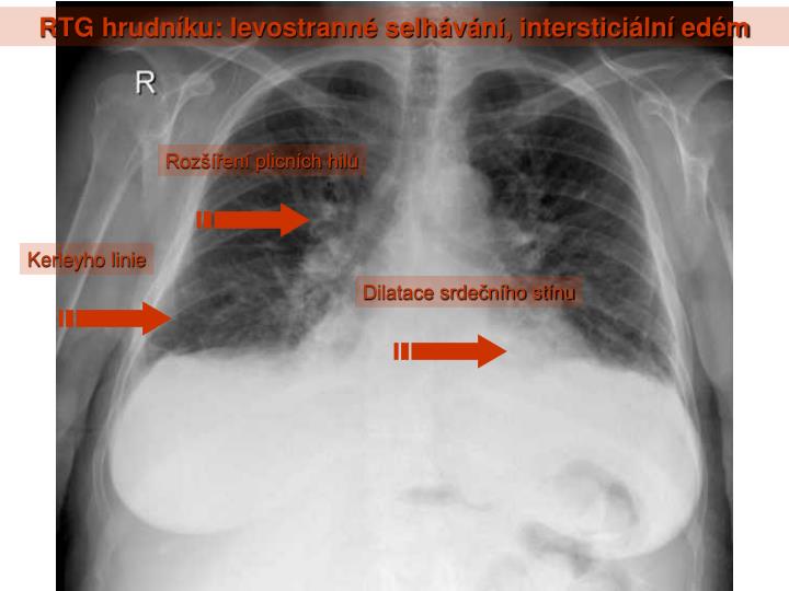 PPT - RTG hrudníku: pleurální výpotek vpravo PowerPoint Presentation ...